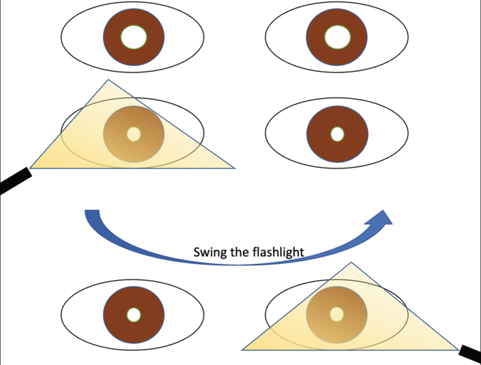 The Pupil and Pupillary Reflexes | SpringerLink