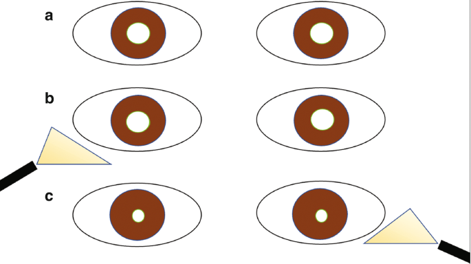 The Pupil and Pupillary Reflexes | SpringerLink
