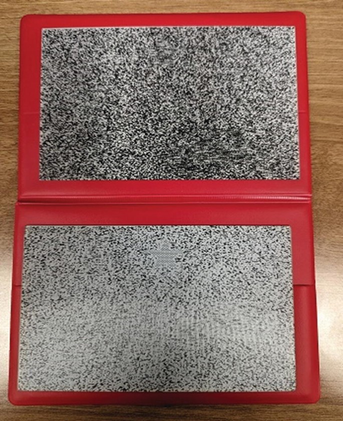 Clinical Measurement of Stereoacuity | SpringerLink