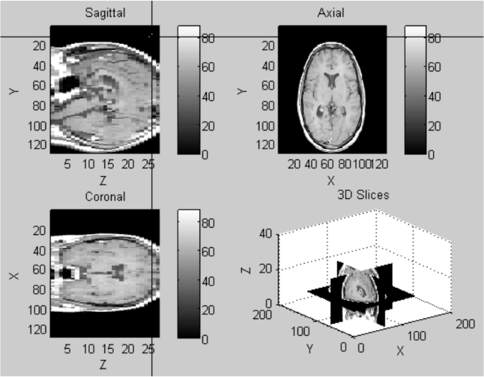 Brain MRI Images for Tumour Detection Using Storage Optimisation ...