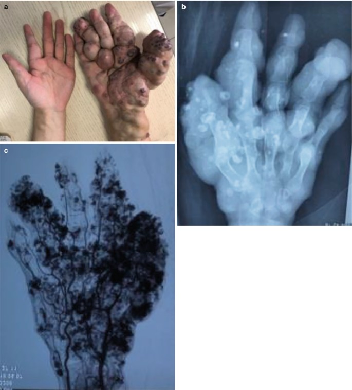 Congenital Upper Limb and Hand Deformities Associate with Genetic ...