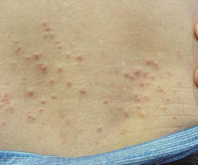 Prurigo, Prurigo Simplex | SpringerLink