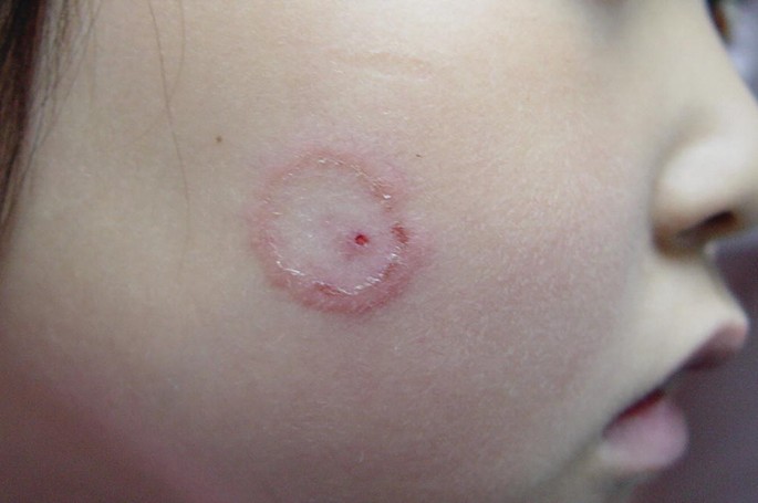 Tinea Faciei: Tinea Faciale | Springer Nature Link