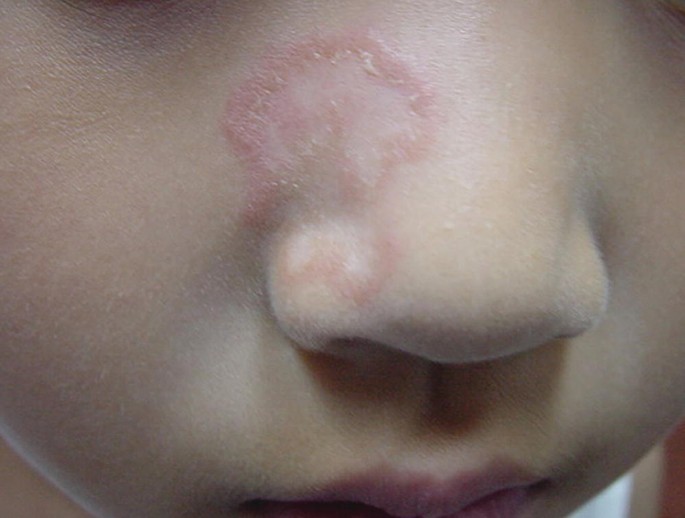 Tinea Faciei: Tinea Faciale | SpringerLink