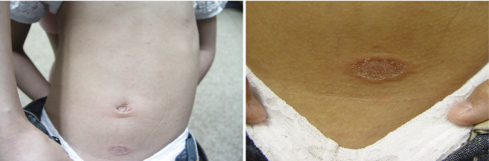 Pityriasis Rosea | SpringerLink