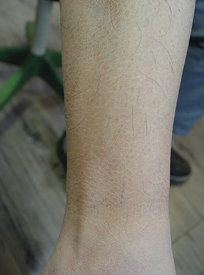Xerotic Eczema: Xerosis Cutis | Springer Nature Link