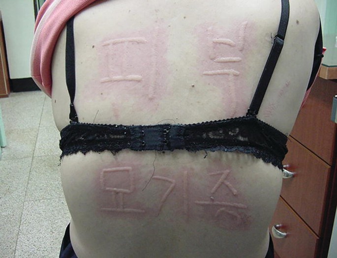 Dermographism: Dermatographism | SpringerLink