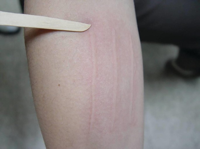 Dermographism: Dermatographism | SpringerLink