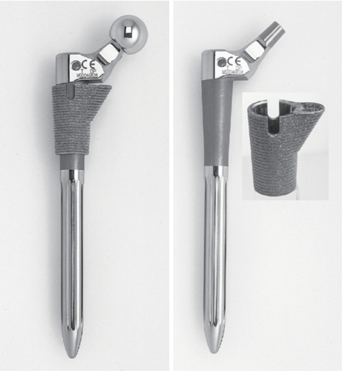 Modular: S-ROM Stem | Springer Nature Link