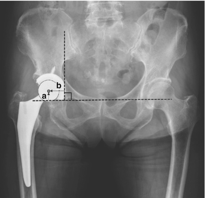 Hip Center | SpringerLink