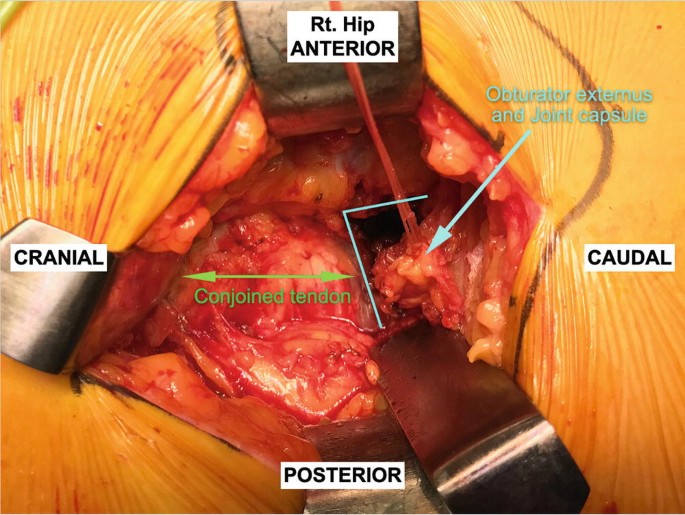 Conjoined Tendon-Preserving Posterior (CPP) Approach | SpringerLink