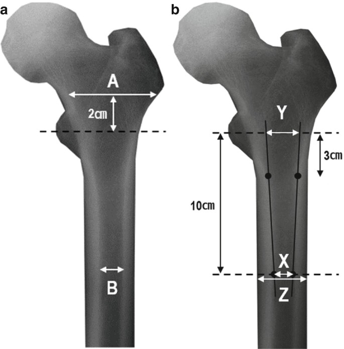 Dorr Classification Type C | SpringerLink