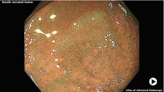 Sessile Serrated Lesion (SSL) | Springer Nature Link