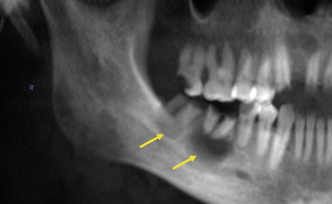 Periapical Pathosis | Springer Nature Link