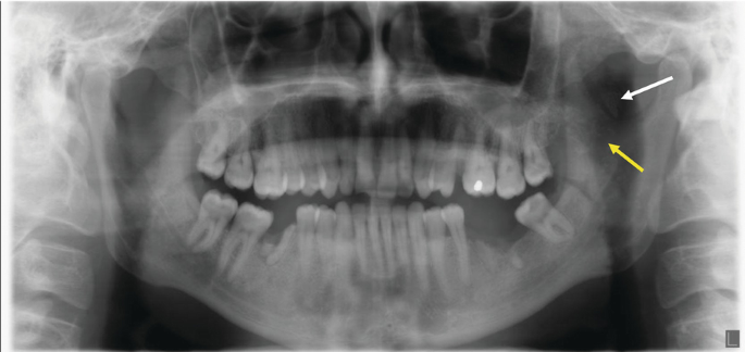 Osteosarcoma | SpringerLink