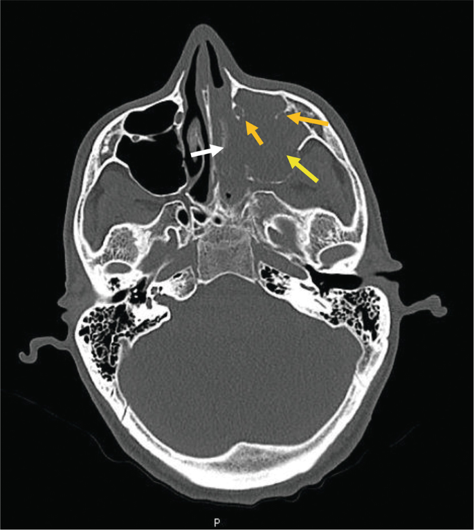 Osteosarcoma | SpringerLink