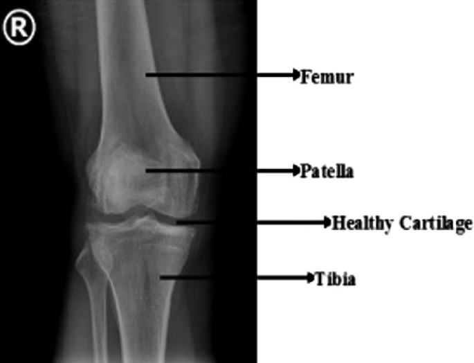 Estimating Severity for Knee Osteoarthritis Radiographs Using Deep ...