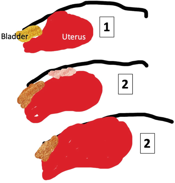 Complex Robotic Hysterectomy: Tackling the Bladder with Previous ...