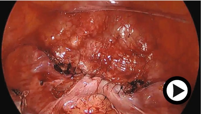 Vaginal Cuff Dehiscence | SpringerLink