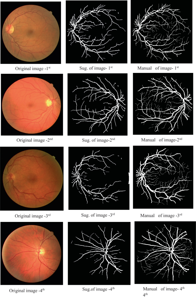 Retinal Vessel Segmentation Using Modify Matching Filter and Hessian ...