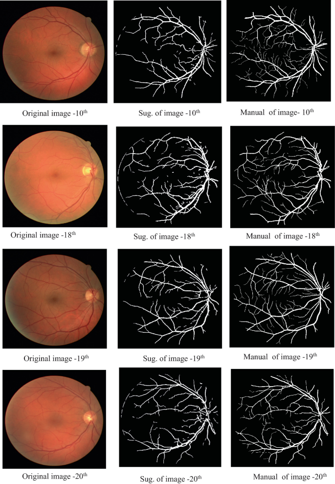 Retinal Vessel Segmentation Using Modify Matching Filter and Hessian ...