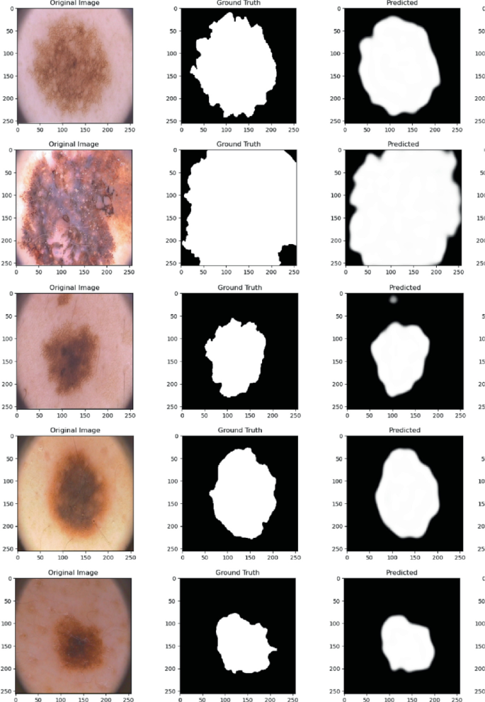 Skin Lesion Segmentation Using Deep Learning | SpringerLink