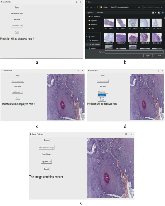 Early Detection of Oral Cancer Using Image Processing and Computational Techniques | Springer ...