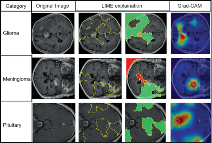 MRI Image-Based Brain Tumor Classification Using Transfer Learning and ...