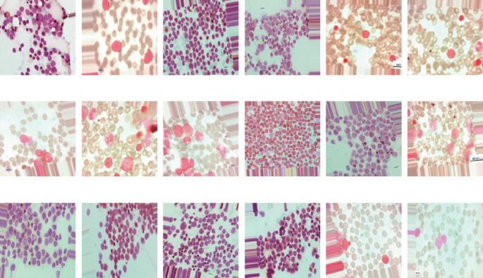 Advanced Hybrid Deep Learning Model for Precise Multiclass Classification of Bone Marrow Cancer ...