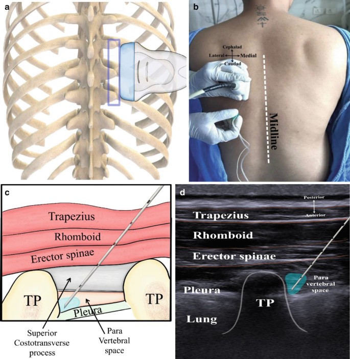 Approach and Troubleshooting to Posterior Truncal Blocks | SpringerLink