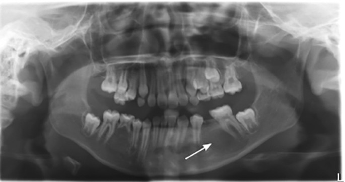 Simple Bone Cyst | SpringerLink