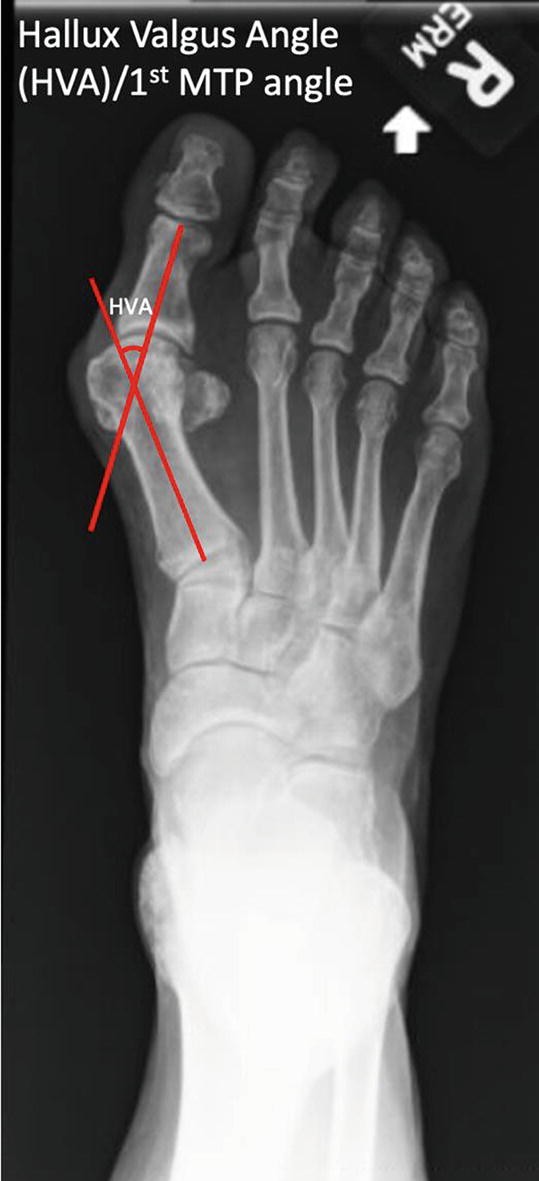 Hallux Disorders | SpringerLink