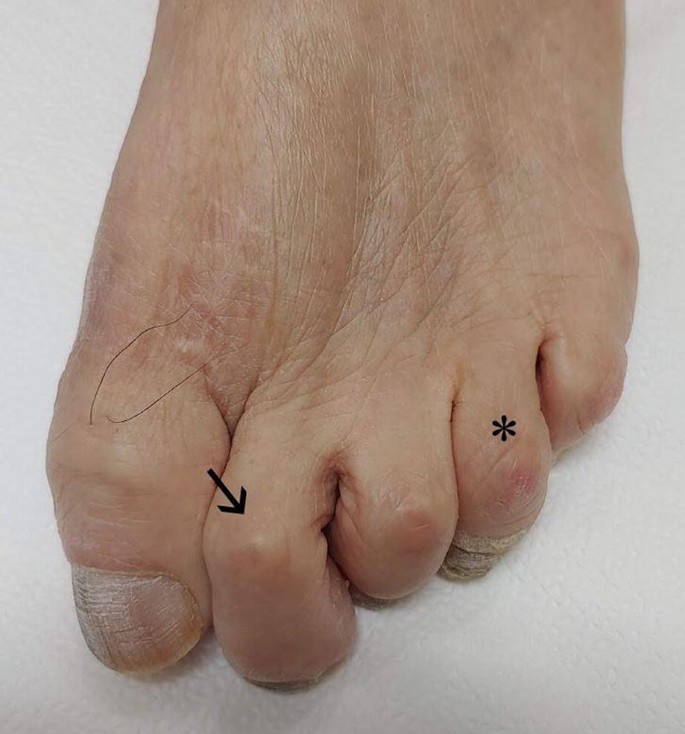 Lesser Toe Disorders | SpringerLink