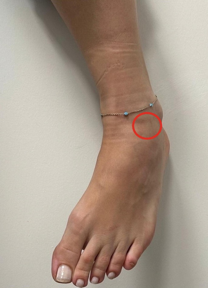 Cartilage Disorders of the Ankle | SpringerLink