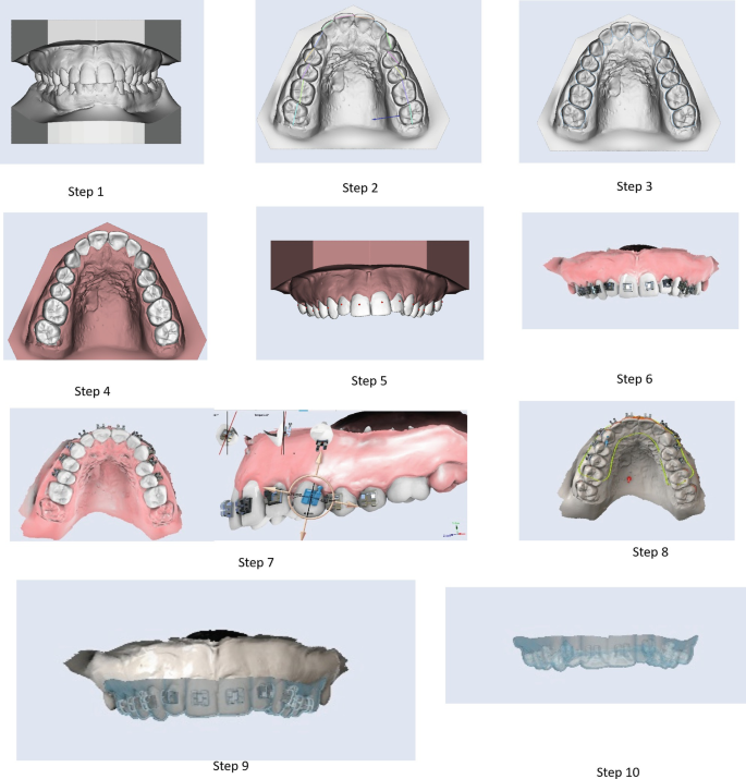 Three-Dimensional Virtual Planning in Orthodontics | SpringerLink