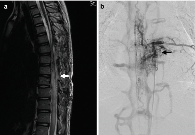 Pathophysiology of Spinal Vascular Malformations | SpringerLink