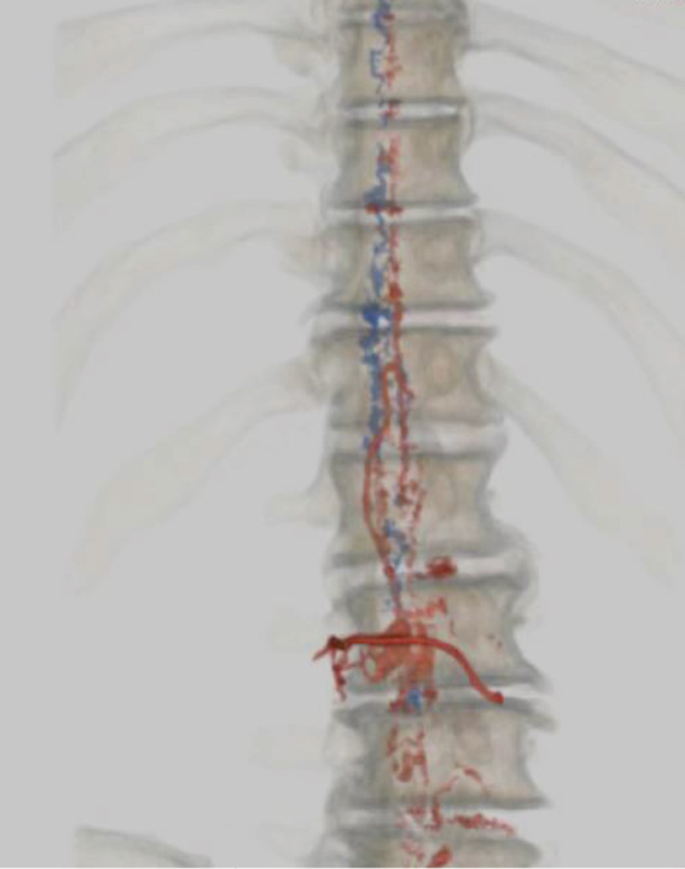 Spinal Dural Arteriovenous Fistulas | SpringerLink