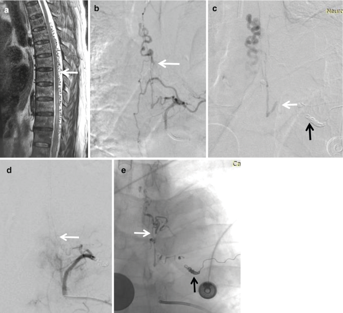Spinal Dural Arteriovenous Fistulas | SpringerLink