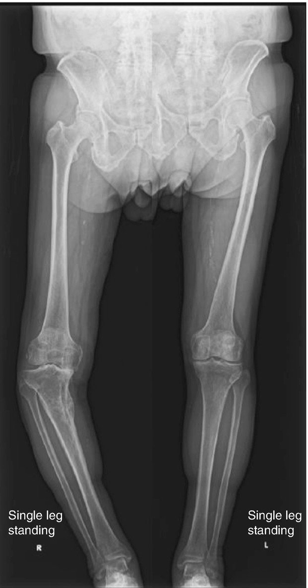 Severe Varus Deformity | Springer Nature Link