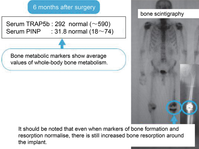 Bone Defects and Osteoporosis | SpringerLink