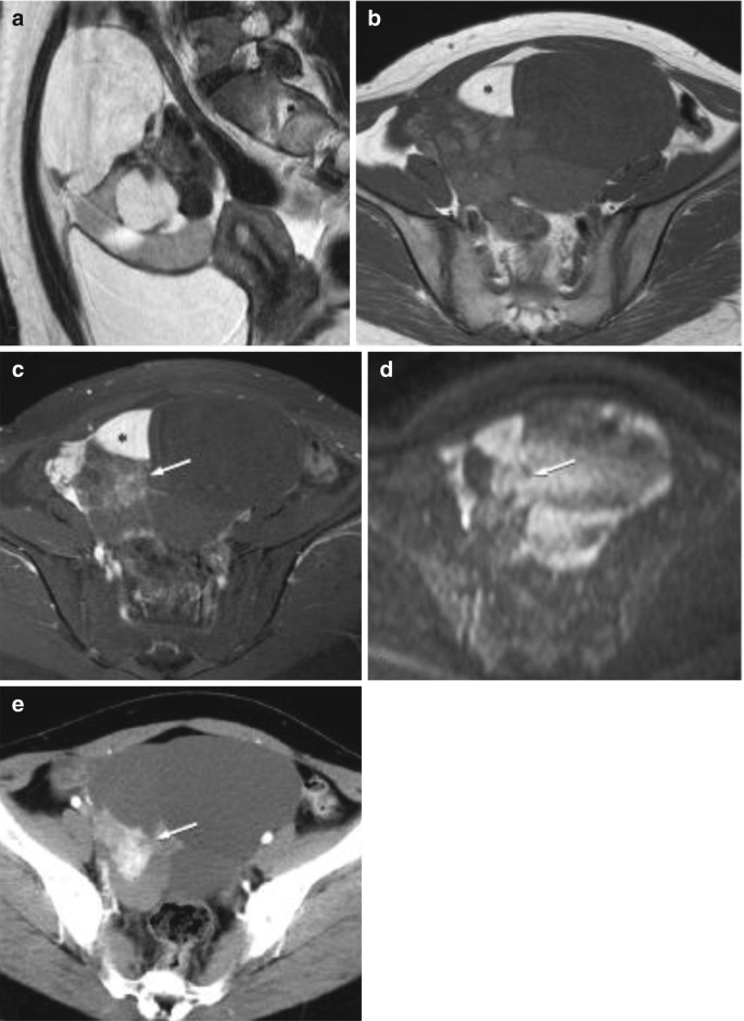 Differential Diagnosis of Ovarian Tumors with Mixed Enhancing and ...