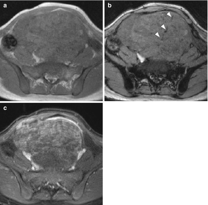 Differential Diagnosis of Mature and Immature Teratomas | SpringerLink