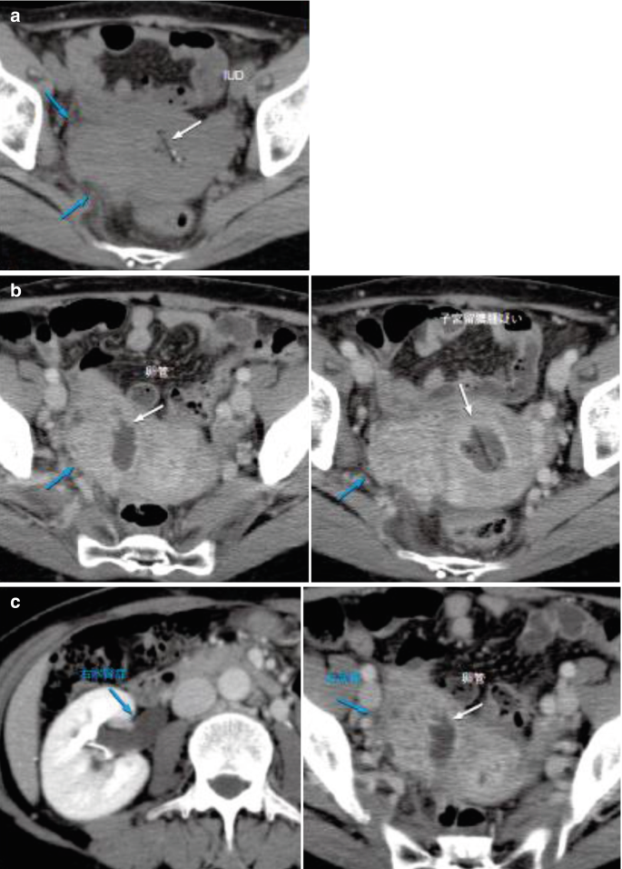 Diagnostic Imaging of Actinomycosis | SpringerLink