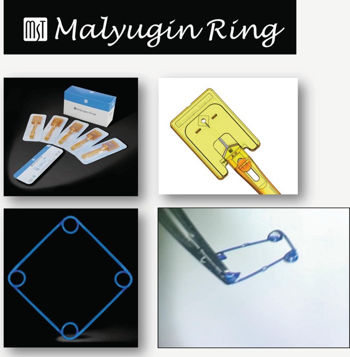 The Malyugin Ring | Springer Nature Link (formerly SpringerLink)
