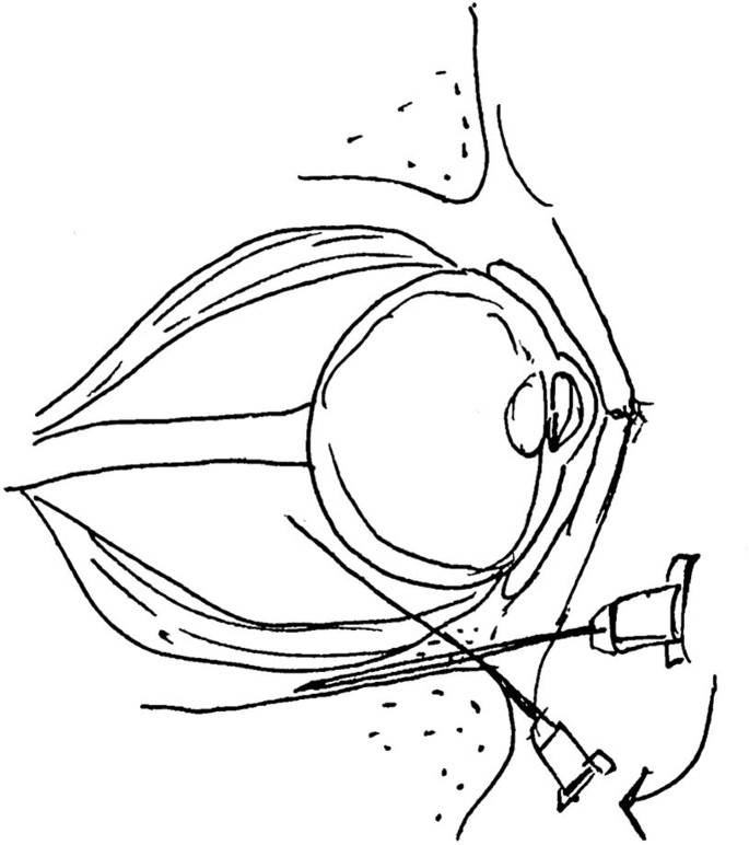 Innovation in Anesthesia for Cataract Surgery | SpringerLink