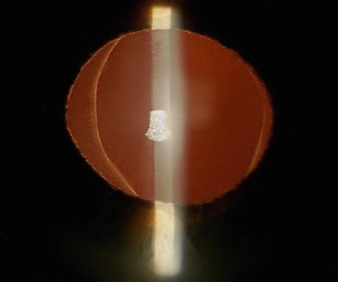 Intraocular Lens Selection in Cataract Surgery | SpringerLink