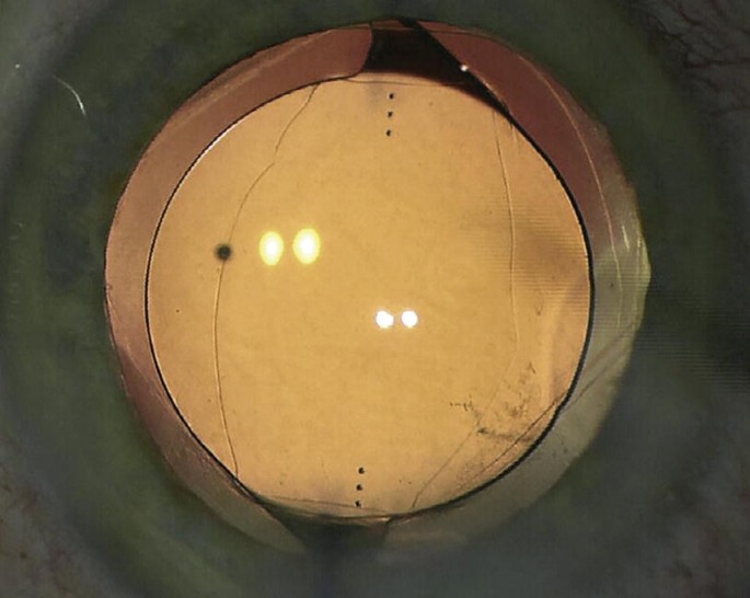 Intraocular Lens Selection in Cataract Surgery | SpringerLink