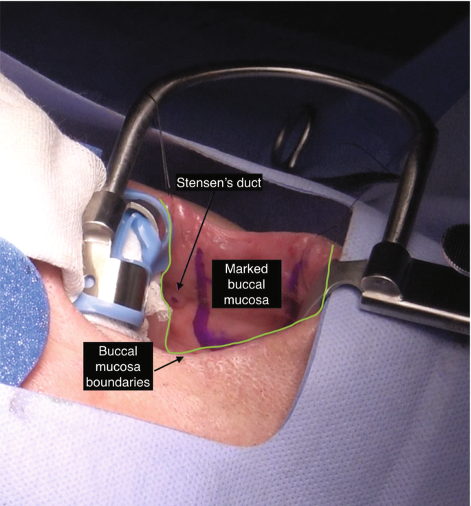 Harvesting of Oral Mucosal Grafts | Springer Nature Link