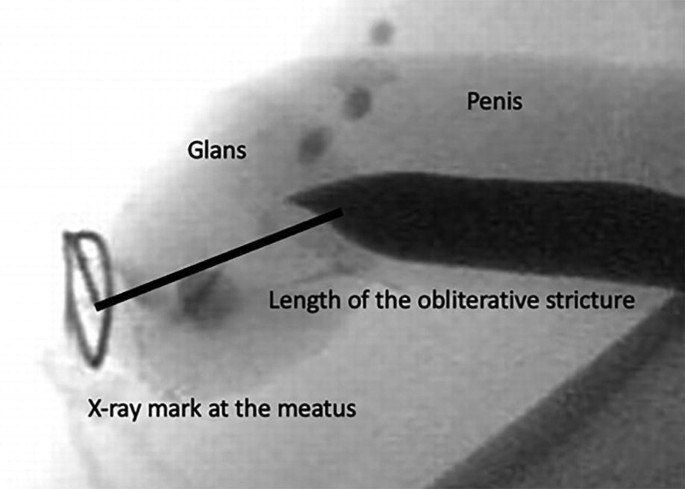 Glans-Preserving Technique for Meatal Stenosis and Glandular Urethral ...