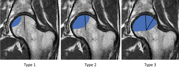 The 2021 Association Research Circulation Osseous Classification for ...